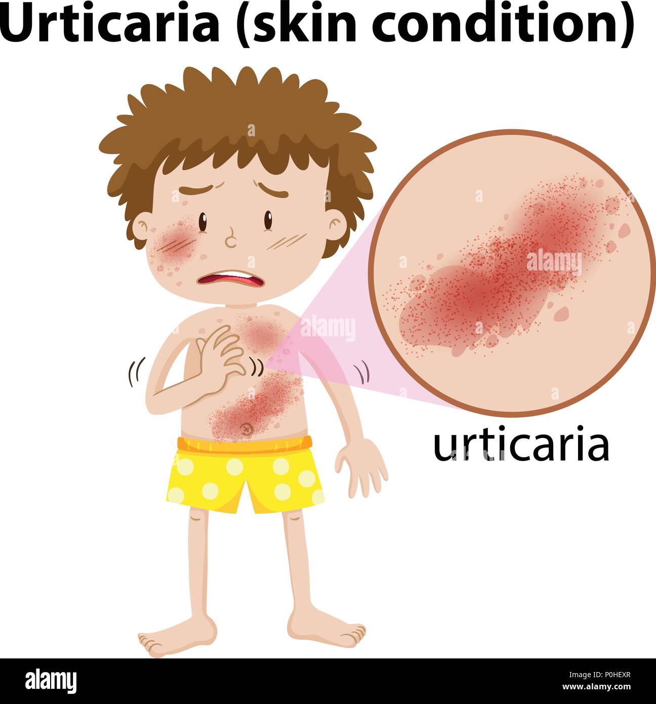 Nettle Rash Stock Photos & Nettle Rash Stock Images - Alamy