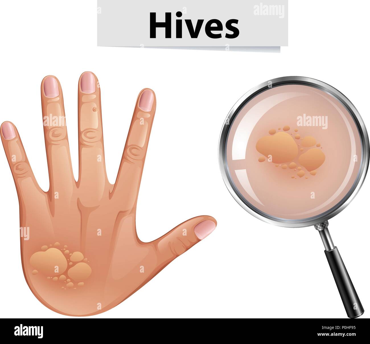 A Vector of Hives on Human Skin illustration Stock Vector Image & Art ...