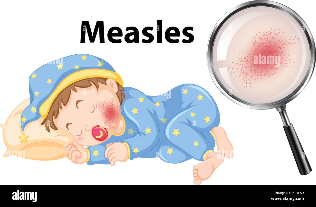 Measles rash face hi-res stock photography and images - Alamy
