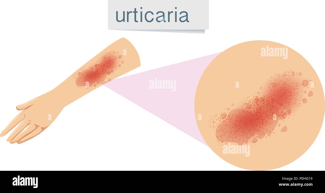 Skin rash urticaria allergic skin hi-res stock photography and images ...