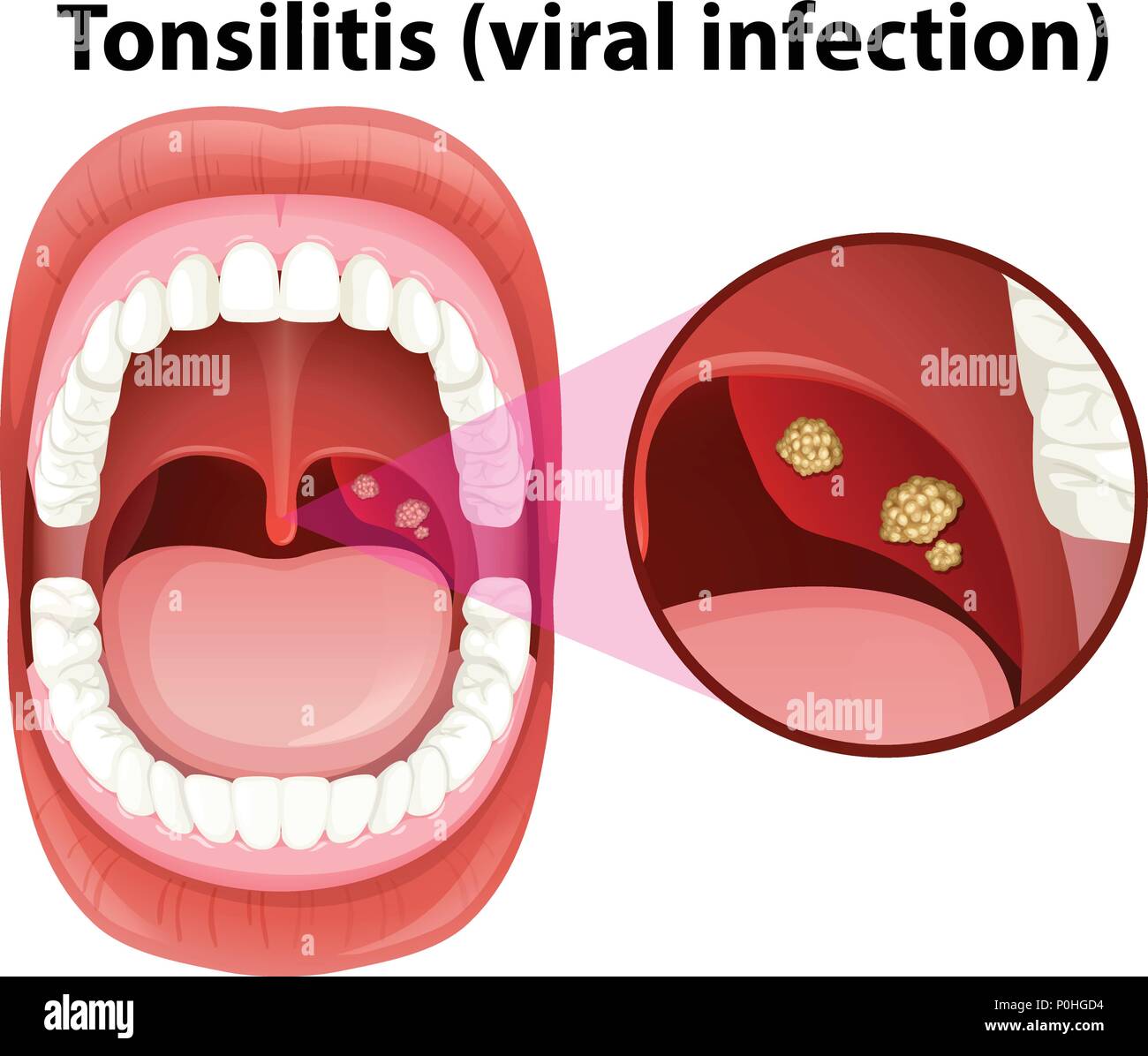 Tonsil Infection