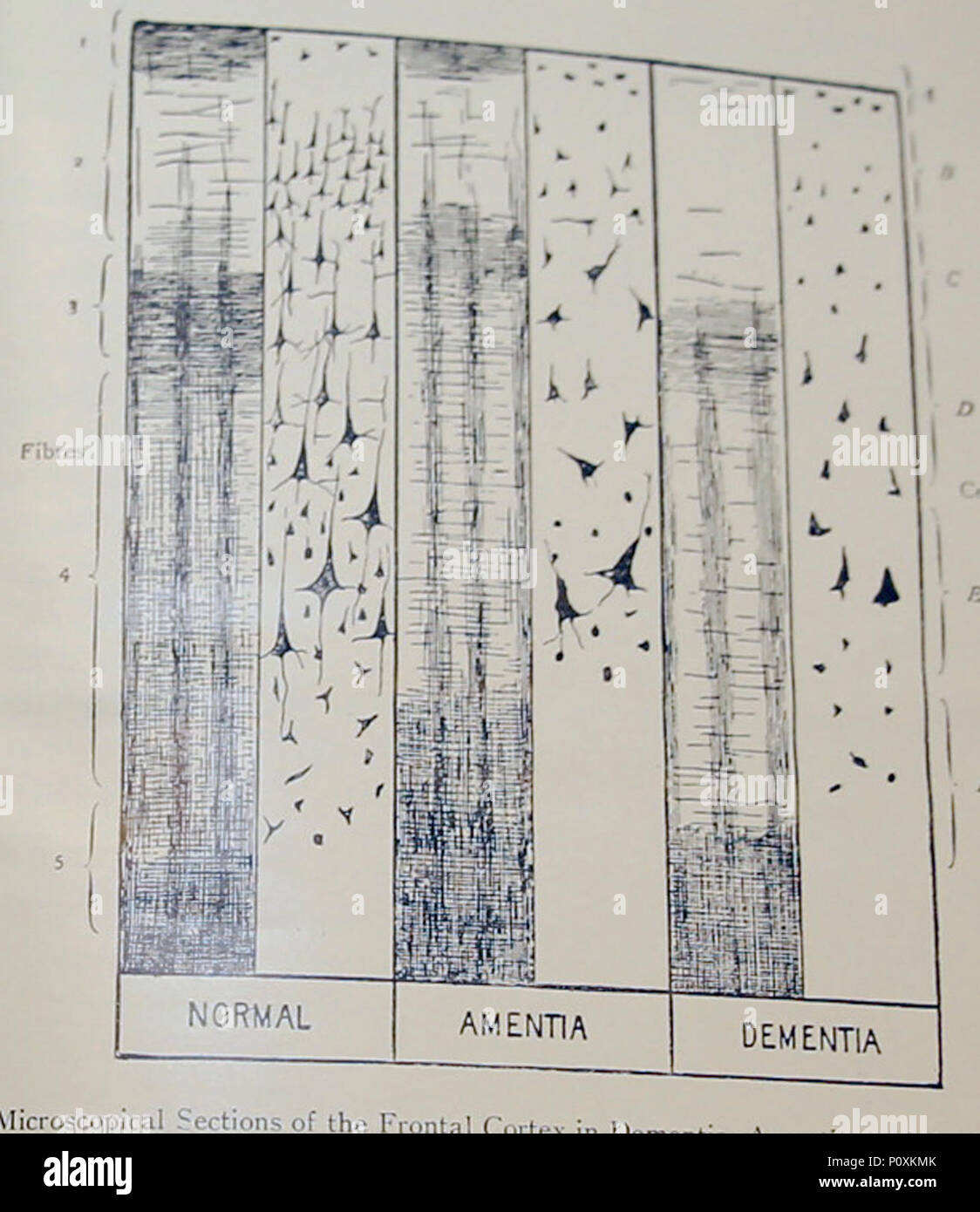'MENTAL DEFICIENCY' (Amentia), FIFTH EDITION, 1929... IMG 3569 edited-3 ...