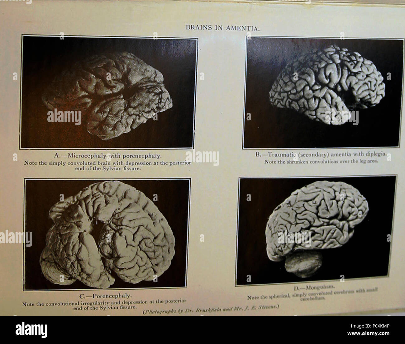 'MENTAL DEFICIENCY' (Amentia), FIFTH EDITION, 1929... IMG 3569 edited-4 ...