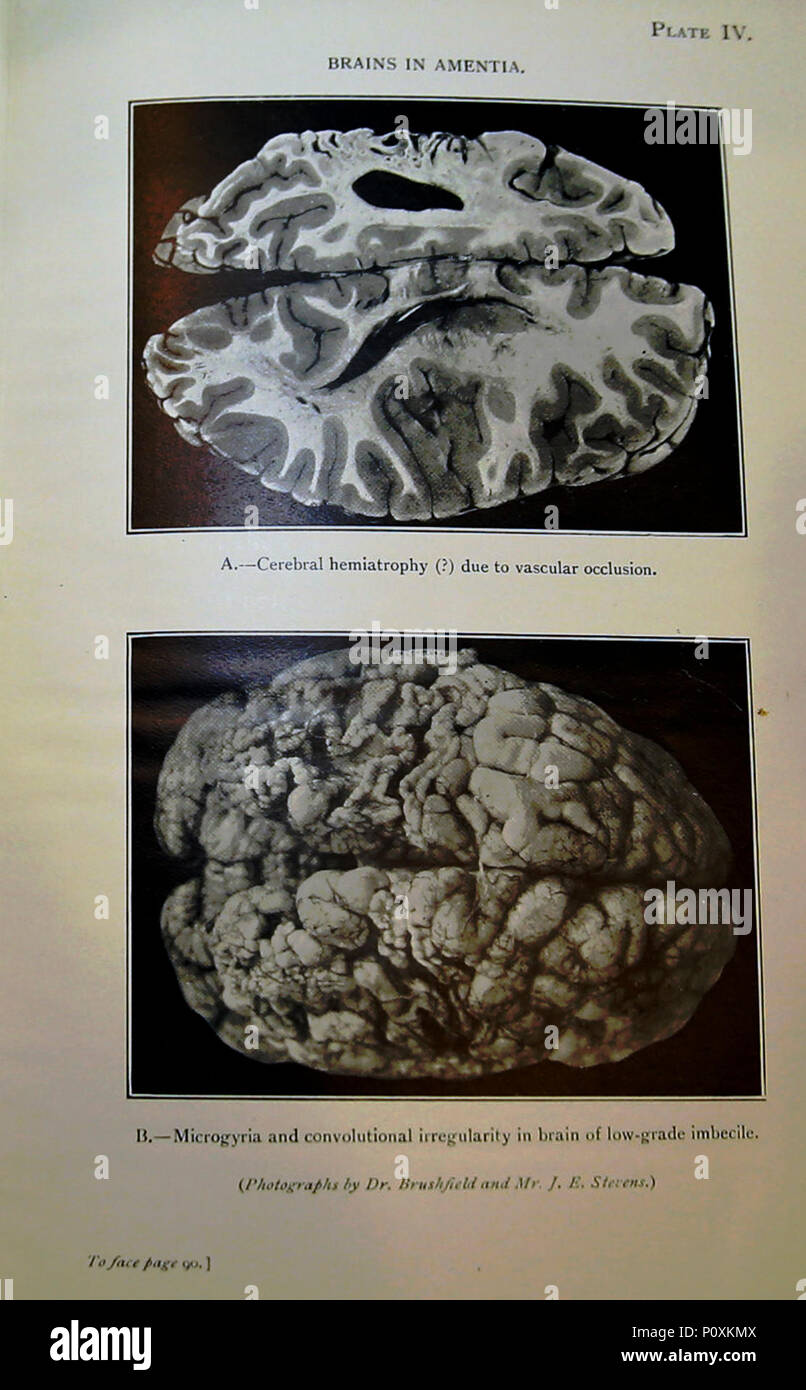'MENTAL DEFICIENCY' (Amentia), FIFTH EDITION, 1929... IMG 3569 edited-6 ...