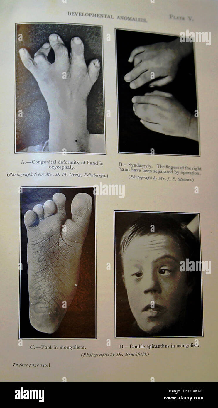 'MENTAL DEFICIENCY' (Amentia), FIFTH EDITION, 1929... IMG 3569 edited-8 ...