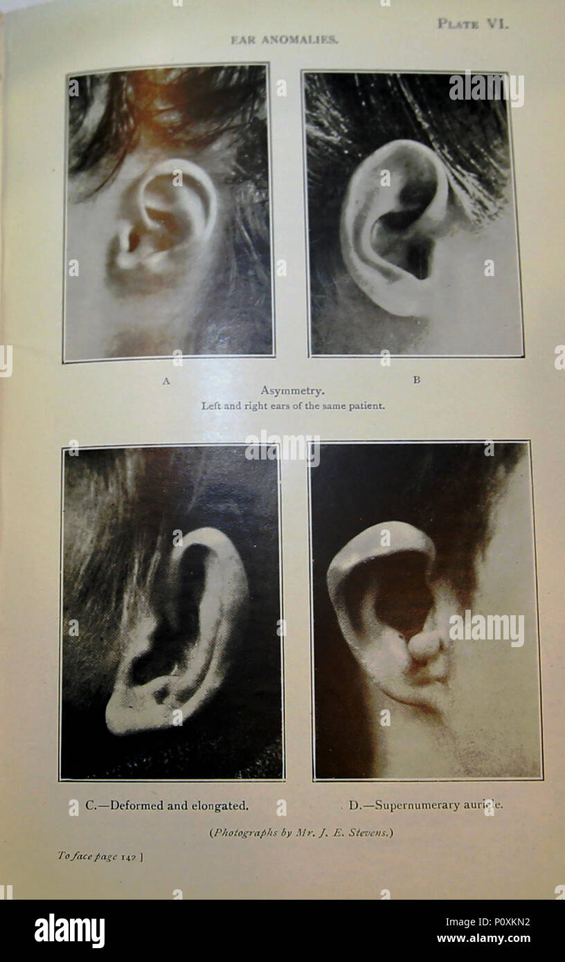 'MENTAL DEFICIENCY' (Amentia), FIFTH EDITION, 1929... IMG 3569 edited-9 ...