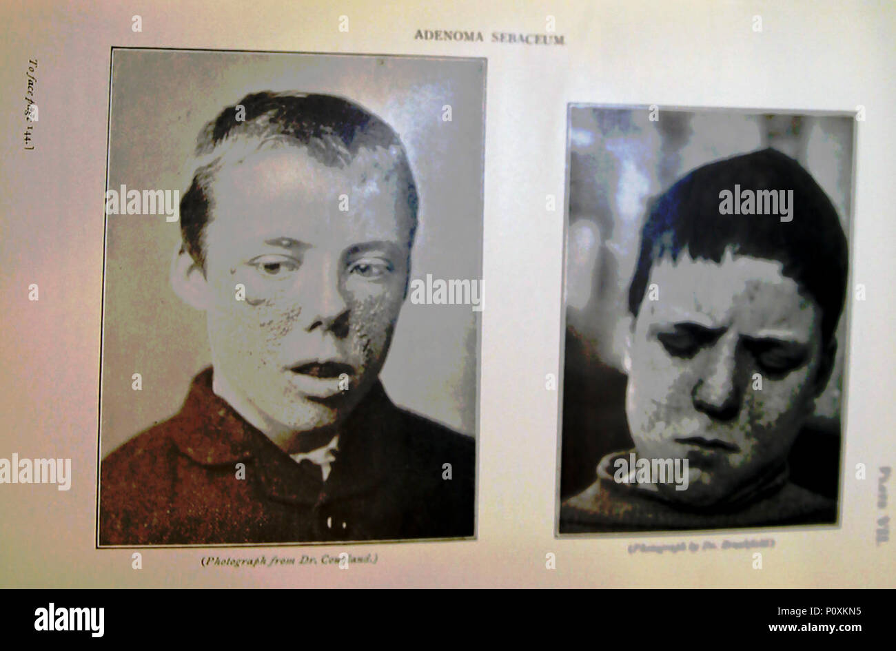 'MENTAL DEFICIENCY' (Amentia), FIFTH EDITION, 1929... IMG 3569 edited ...