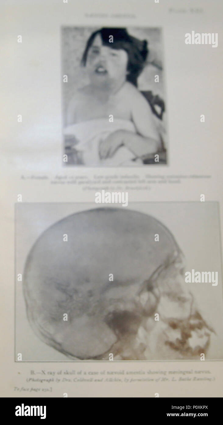 'MENTAL DEFICIENCY' (Amentia), FIFTH EDITION, 1929... IMG 3569 edited ...