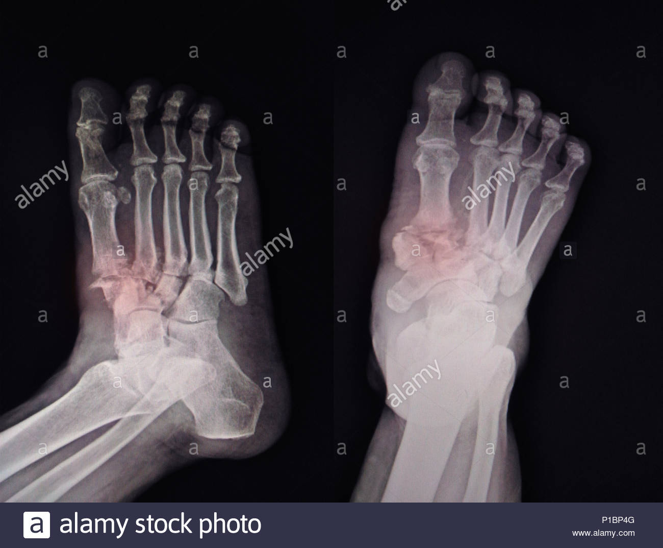 Proximal Phalanx Stock Photos & Proximal Phalanx Stock Images - Alamy