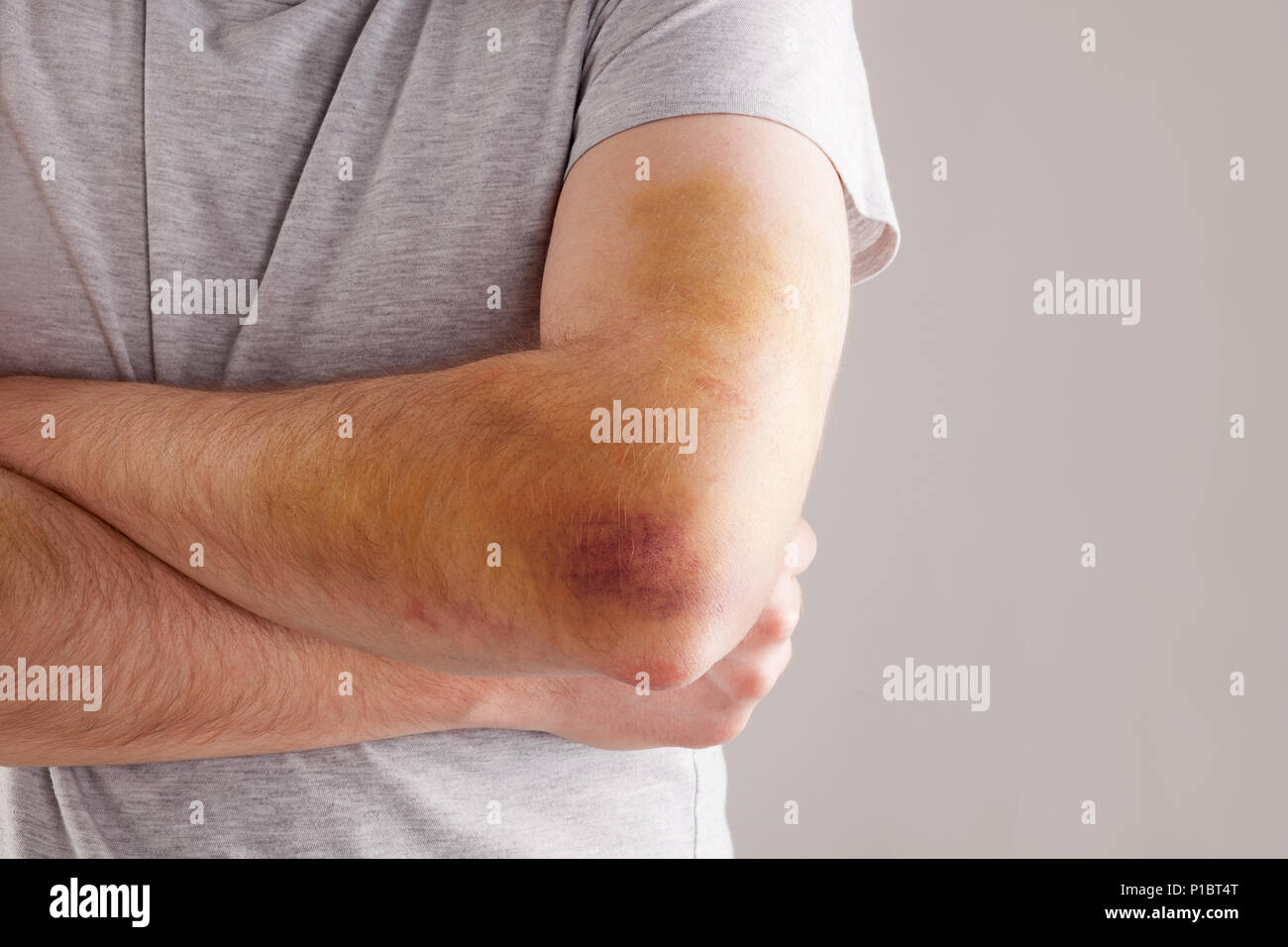 Handsome man with big bruise on forearm, elbow and arm. Sport injury ...