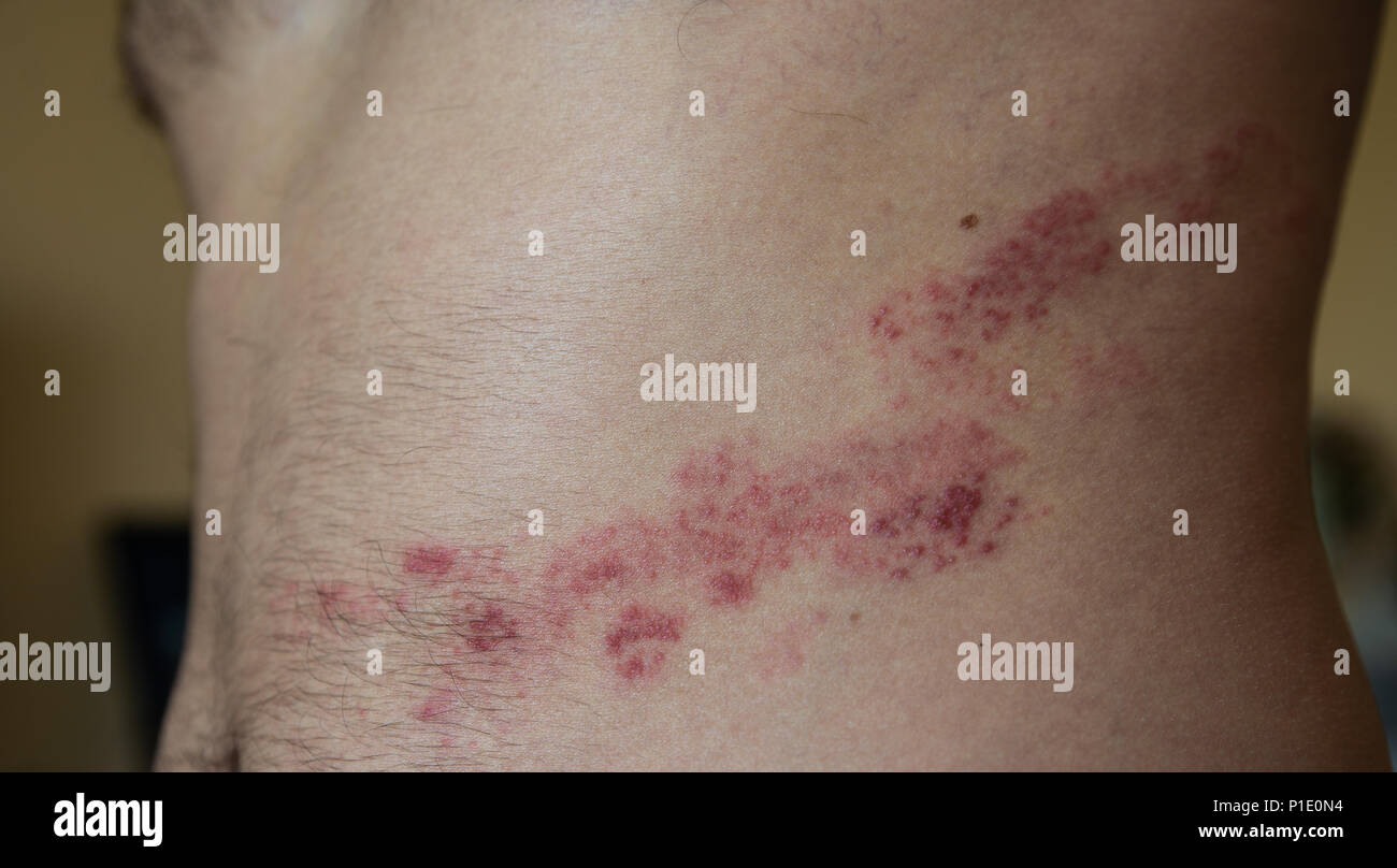 Herpes zoster hi-res stock photography and images - Alamy