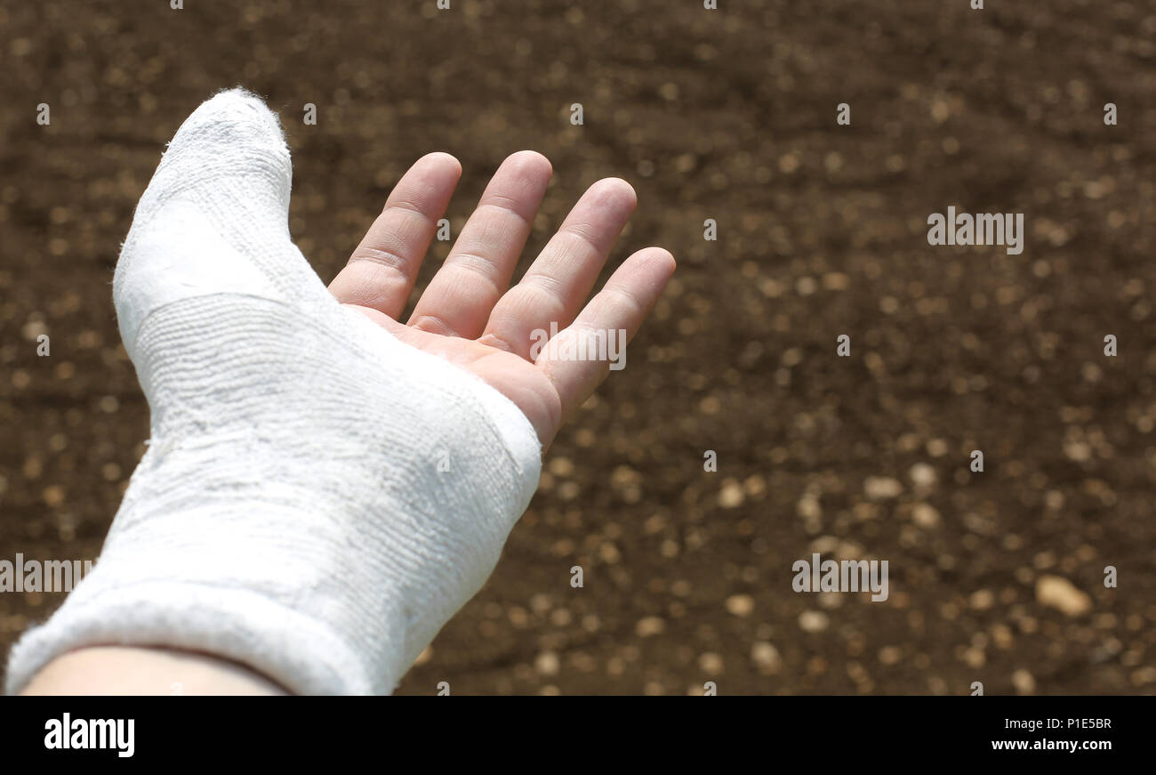 Hand of the injured person with the bone fracture of the thumb Stock ...