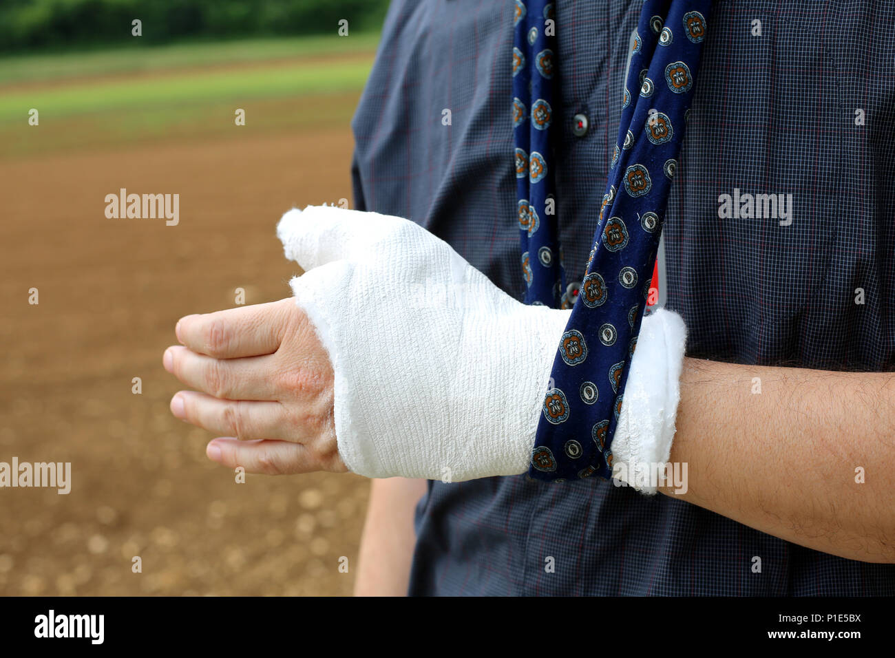Hand of the injured person completely blindfolded after the fracture of ...