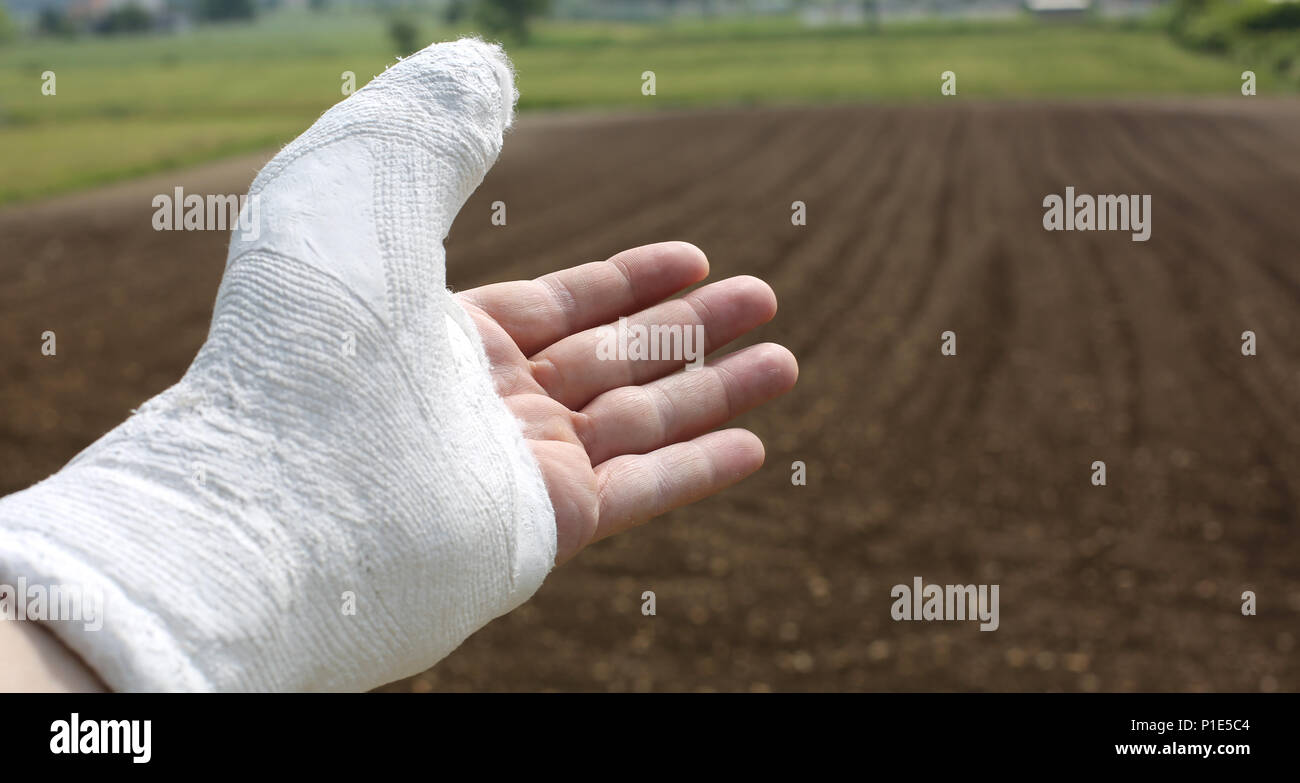 Left arm in plaster hi-res stock photography and images - Alamy