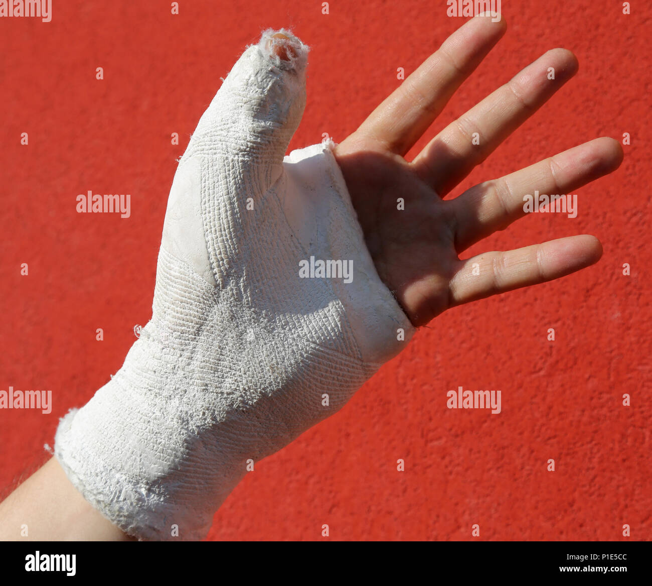 fractured hand with plaster on the red background Stock Photo - Alamy