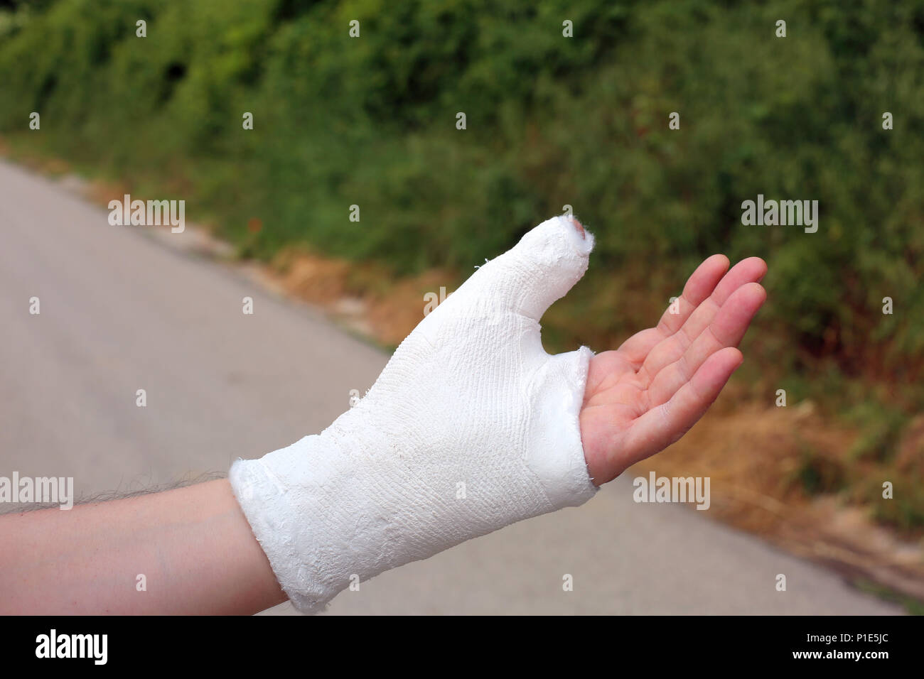 hand of a man with the thumb plastered due to a domestic accident Stock ...