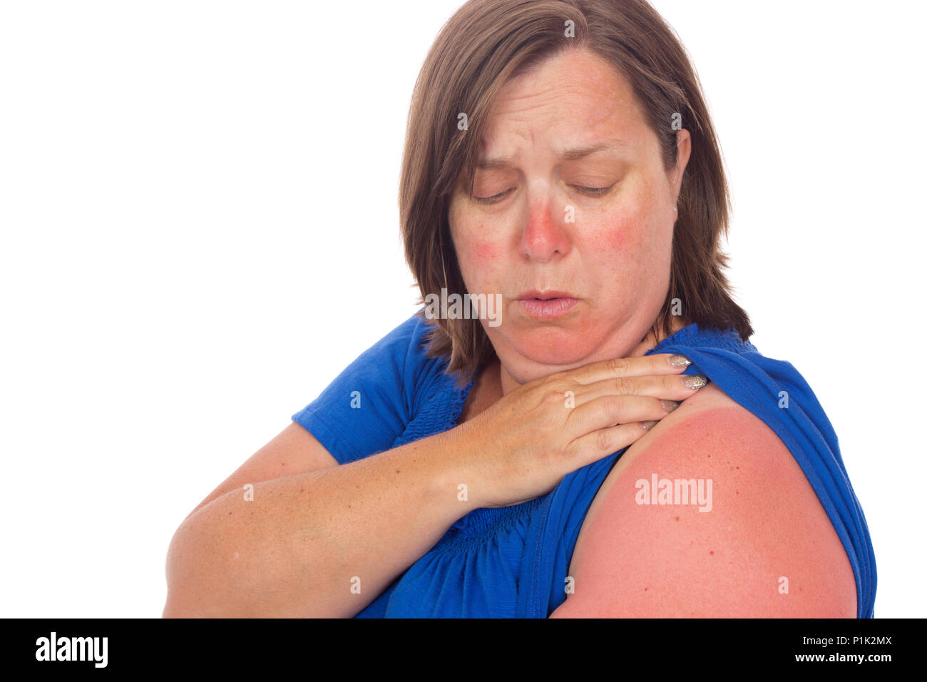 Sunburned sunburnt face hi-res stock photography and images - Alamy