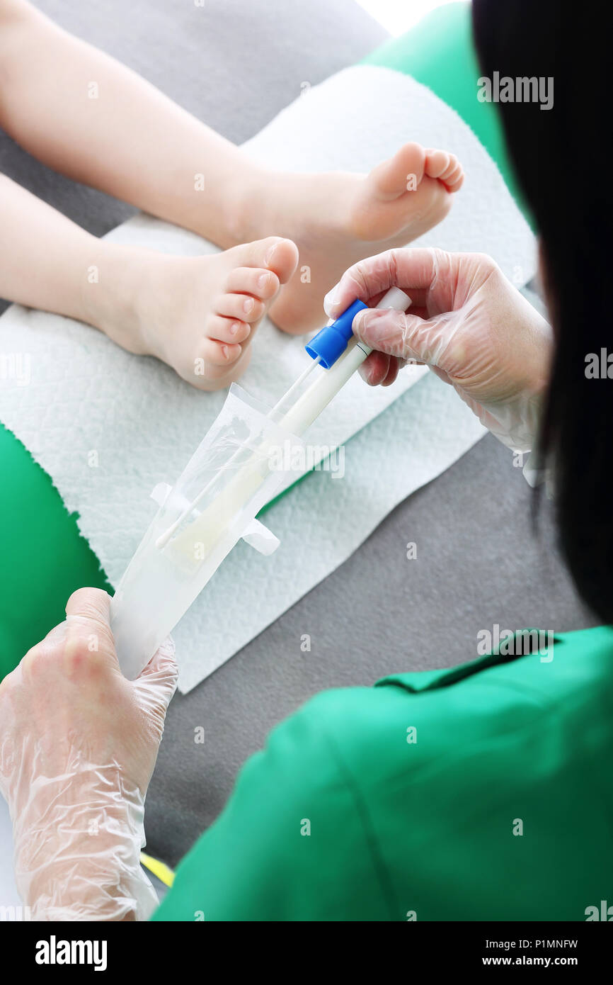 Mycosis of the feet and nails. The dermatologist takes a swab from the ...