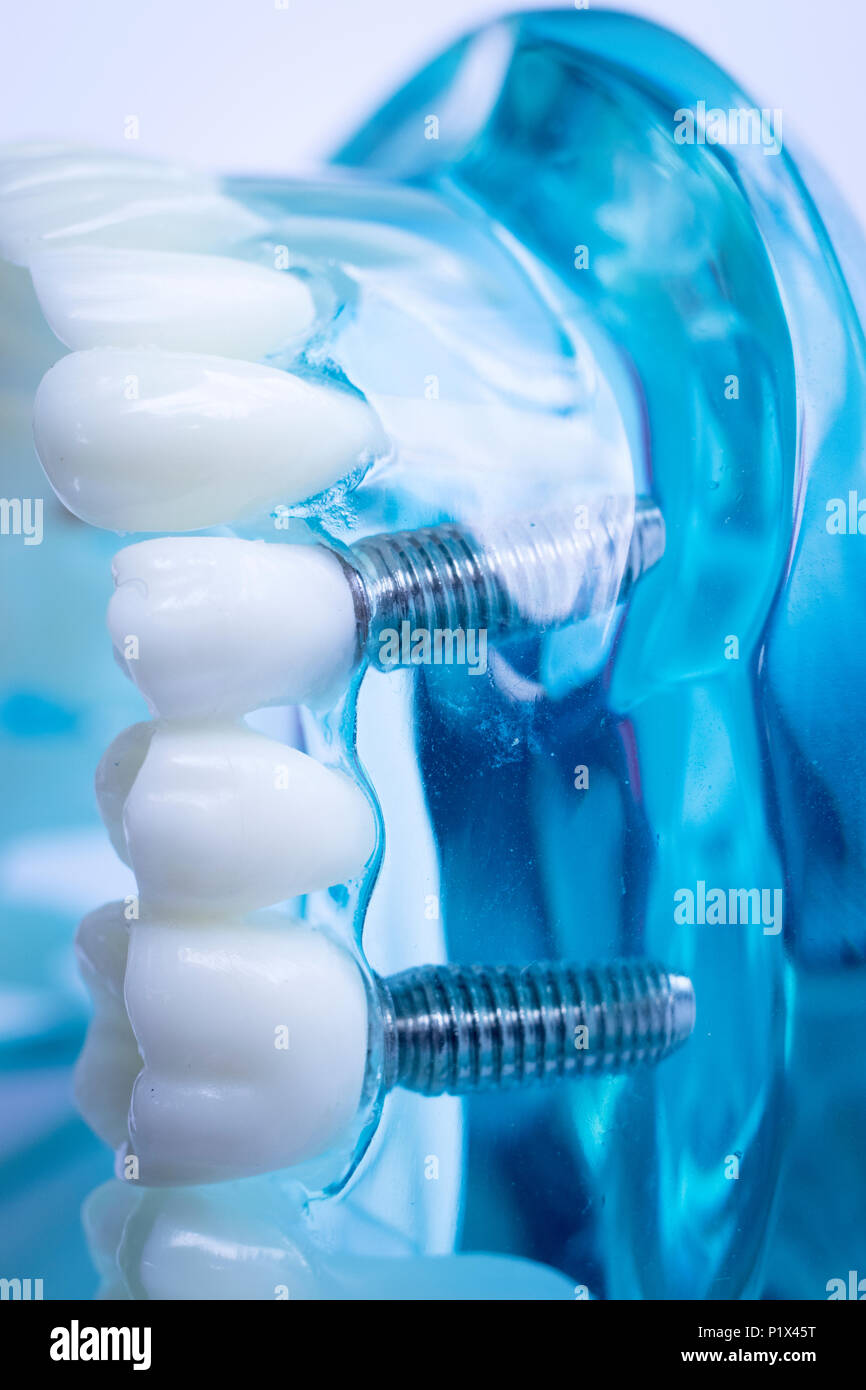 Dentist dental teeth teaching model showing titanium metal tooth ...