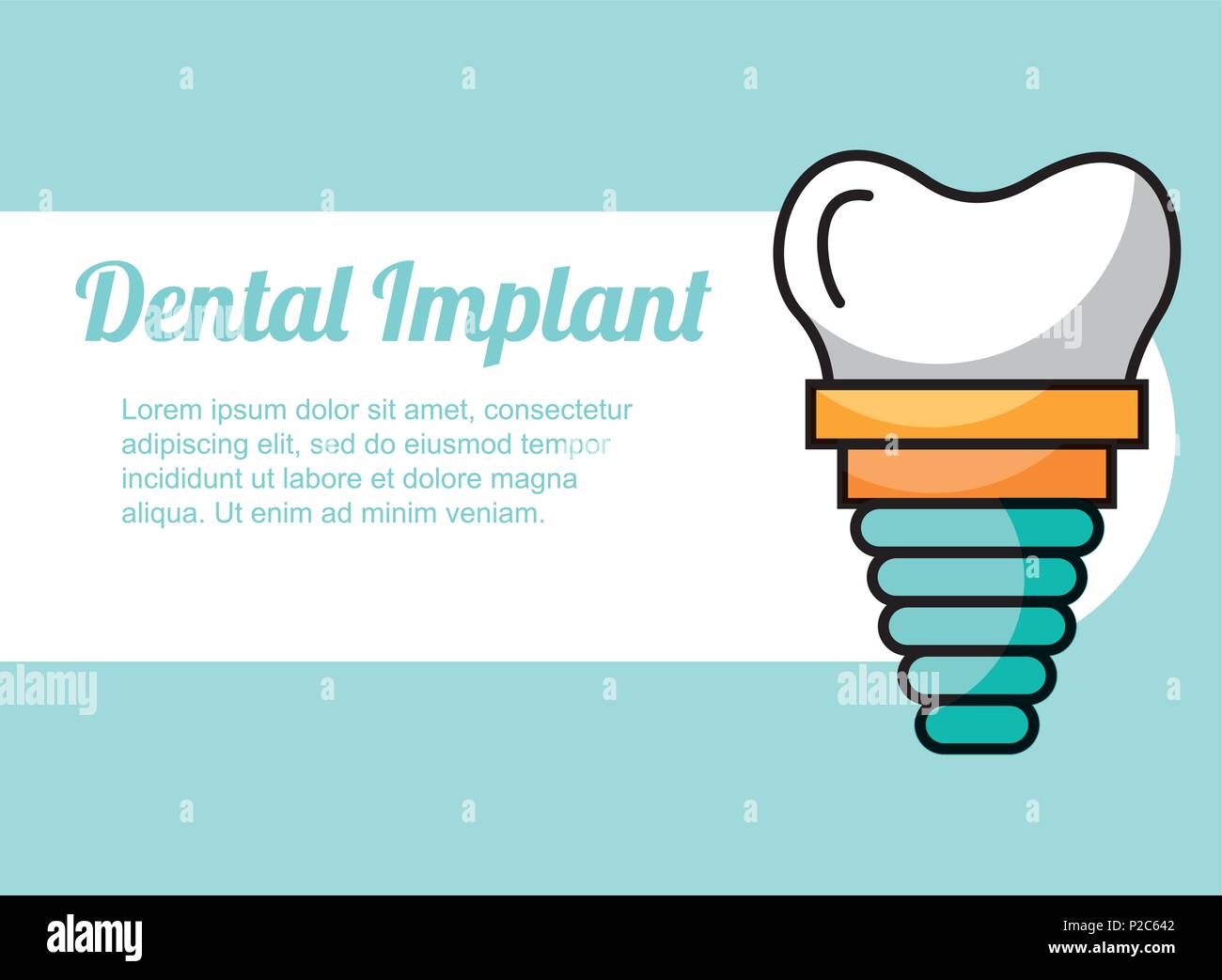Dental tooth implant titanium Stock Vector Images - Alamy