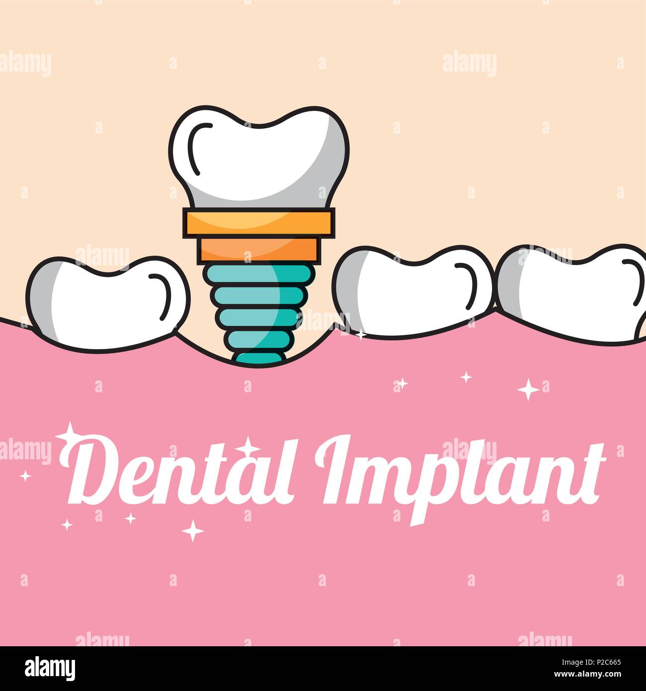 dental implant tooth and gum inside mouth Stock Vector Image & Art - Alamy