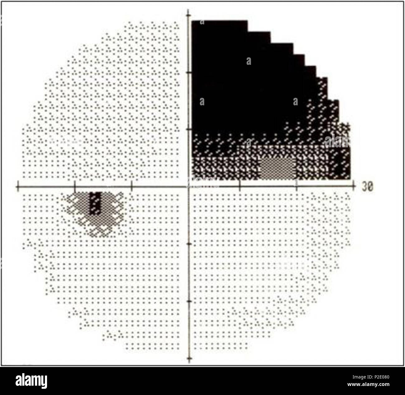 . English: This shows the sharp definition between the intact and ...
