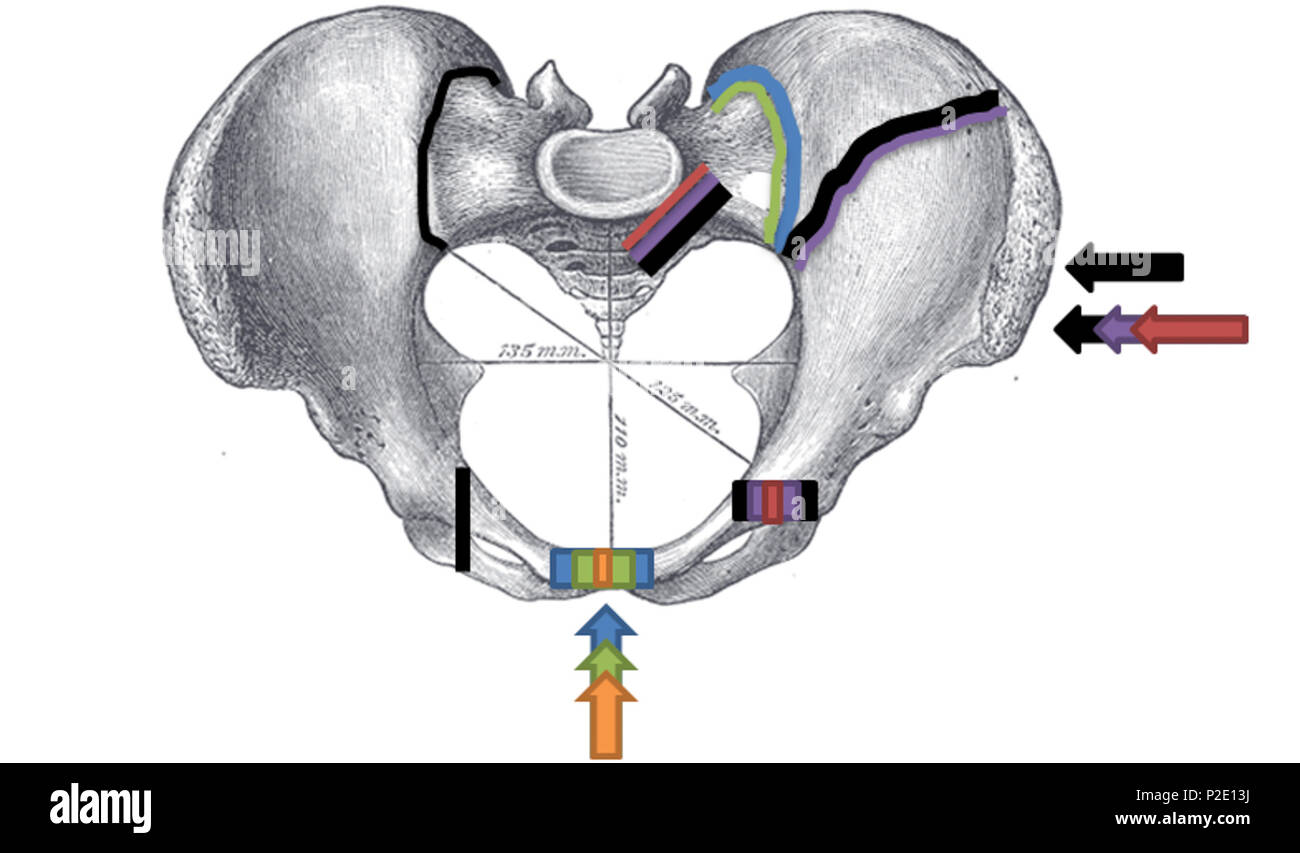 40 Pelvic Fracture Young-Burgess Classification Stock Photo - Alamy