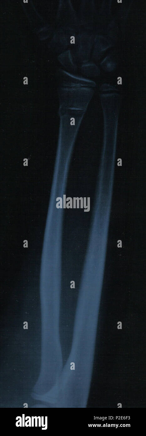 . Fractured radius with approx 10o lateral angulation. Subject was 11yr ...