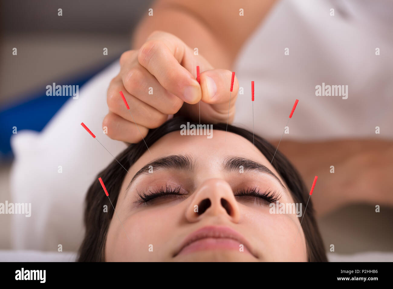 Beautiful Young Woman Getting Acupuncture Treatment In Beauty Spa Stock ...