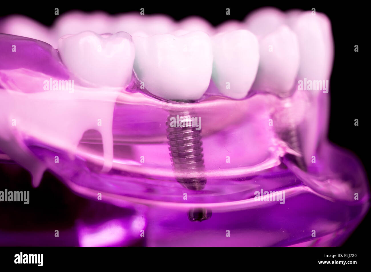 Dentist dental teeth teaching model showing titanium metal tooth ...