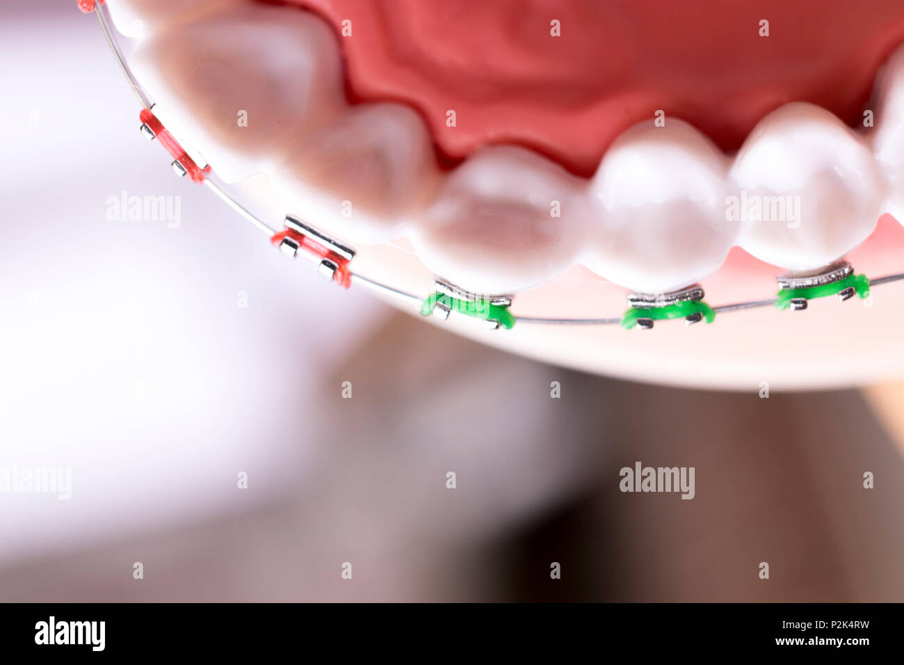 Dental metal braces teeth retainer aligners teaching orthodontics model ...