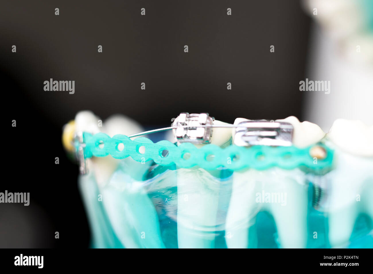 Dental metal braces teeth retainer aligners teaching orthodontics model ...