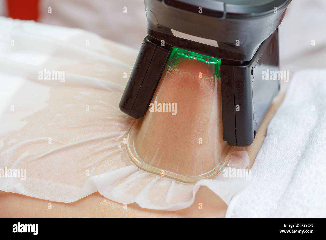 Woman getting cryolipolysis fat treatment procedure in professional ...
