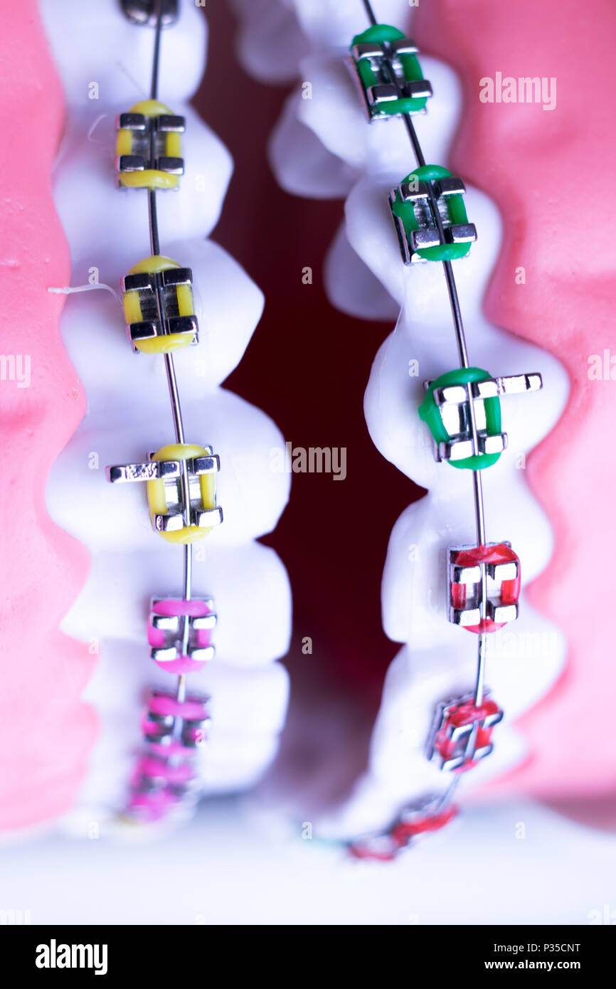 Dental metal braces teeth retainer aligners teaching orthodontics model ...
