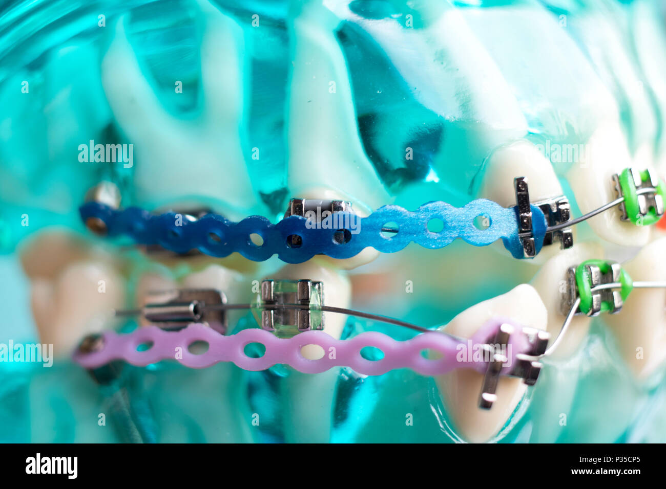 Dental metal braces teeth retainer aligners teaching orthodontics model ...