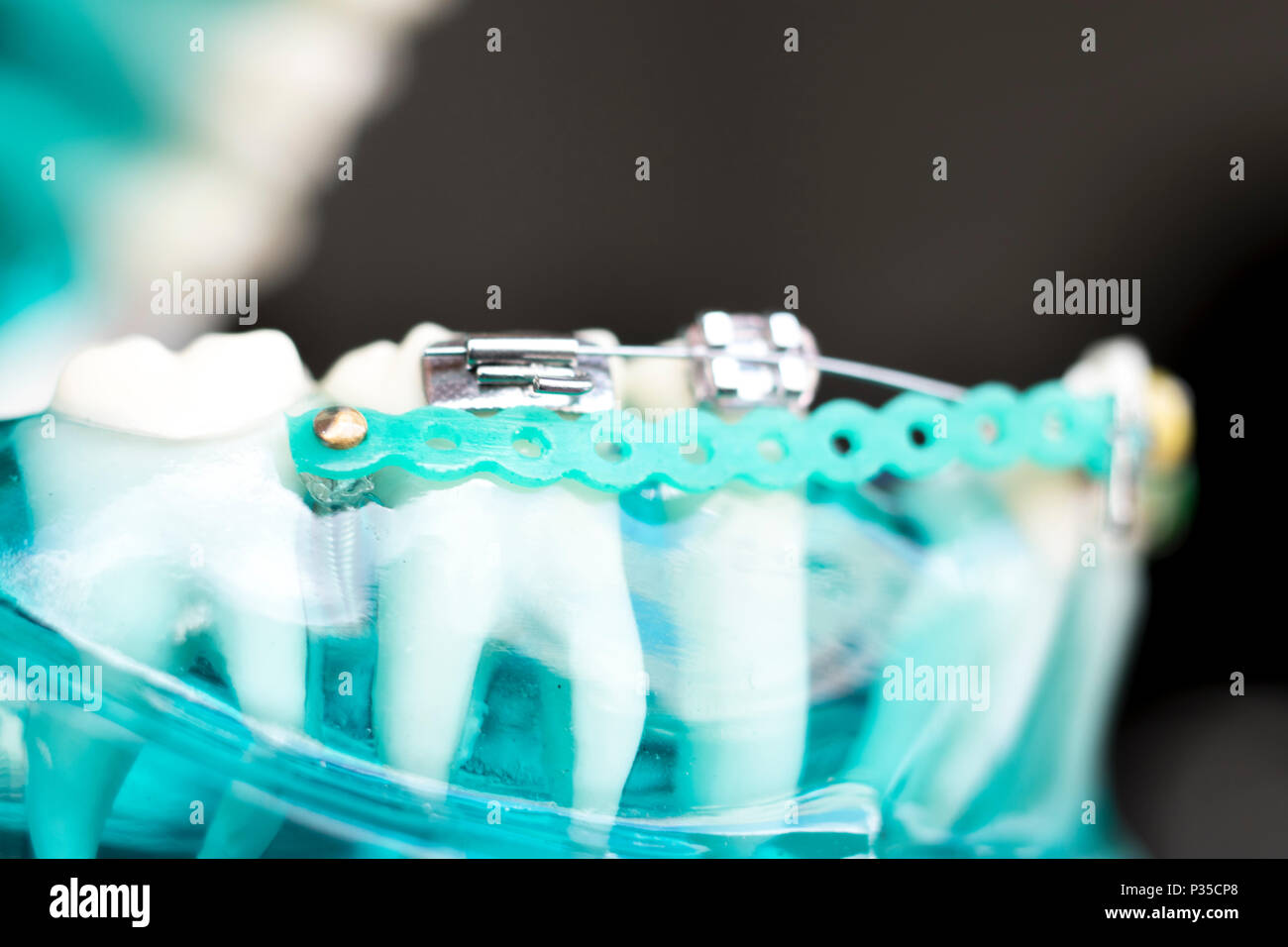 Dental metal braces teeth retainer aligners teaching orthodontics model ...