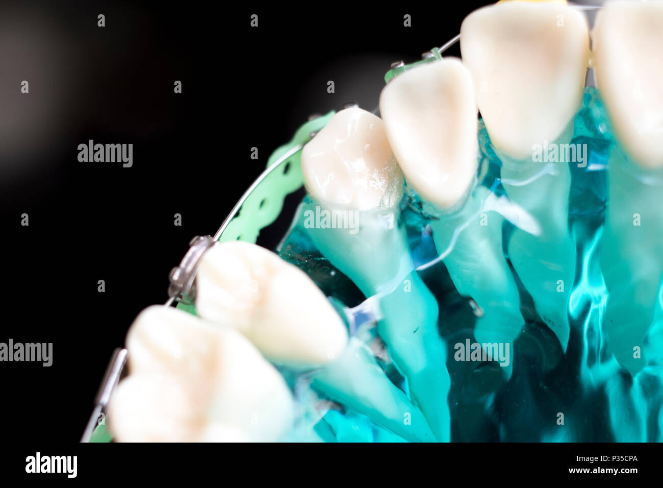 Dental metal braces teeth retainer aligners teaching orthodontics model ...