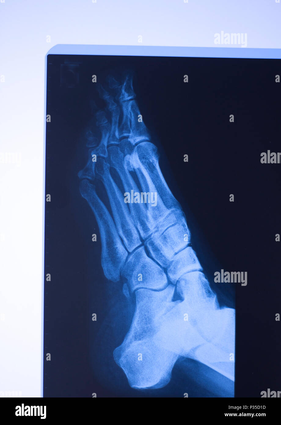 Medical hospital x-ray feet traumatology scan Stock Photo - Alamy