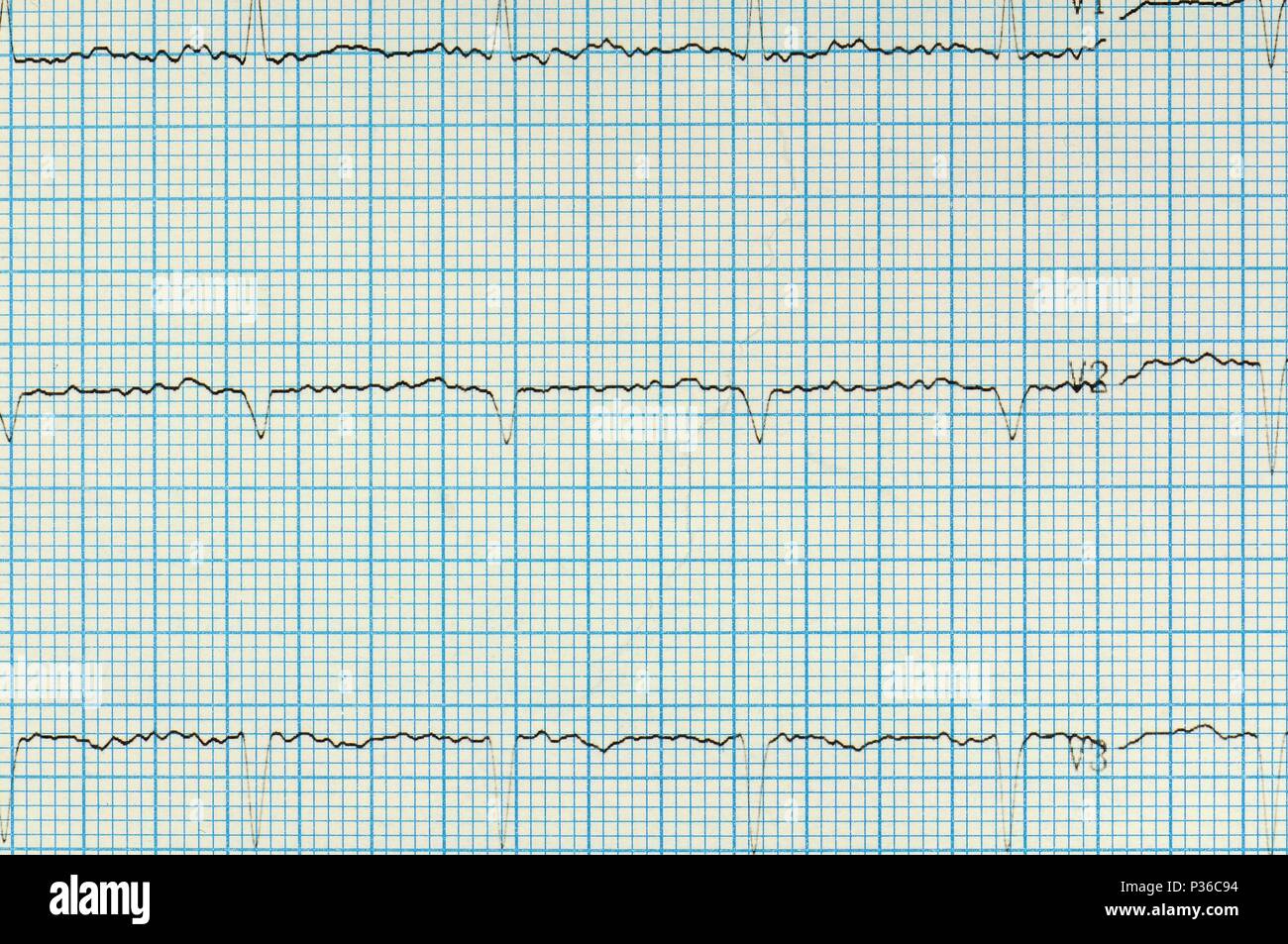 Ecg graph heart diagnose hi-res stock photography and images - Alamy