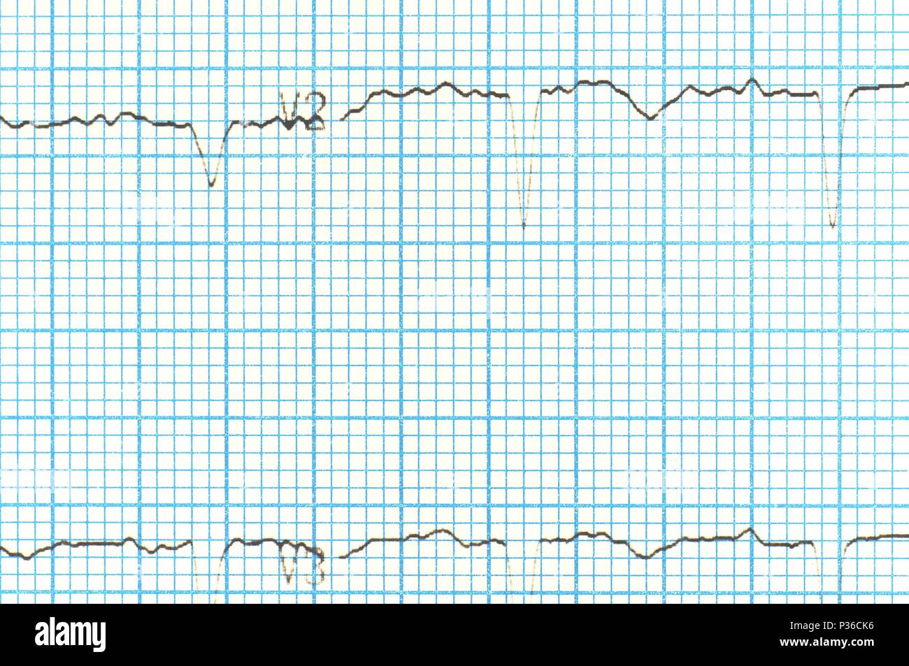 Heart analysis, electrocardiogram graph (ECG Stock Photo - Alamy