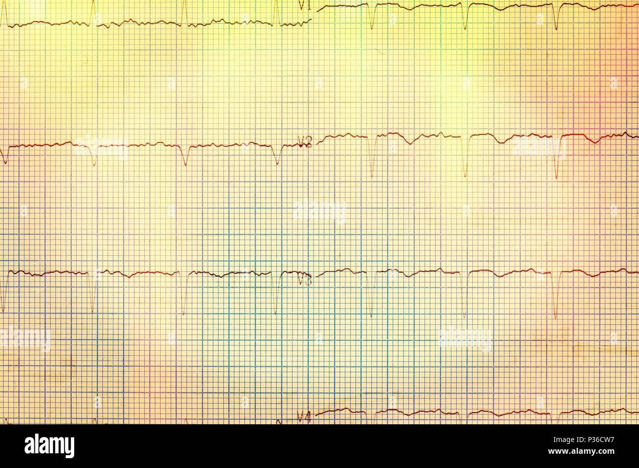 Heart analysis, electrocardiogram graph (ECG Stock Photo - Alamy