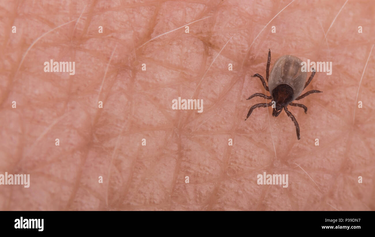 Small deer tick on human skin close-up. Ixodes ricinus. Dangerous ...