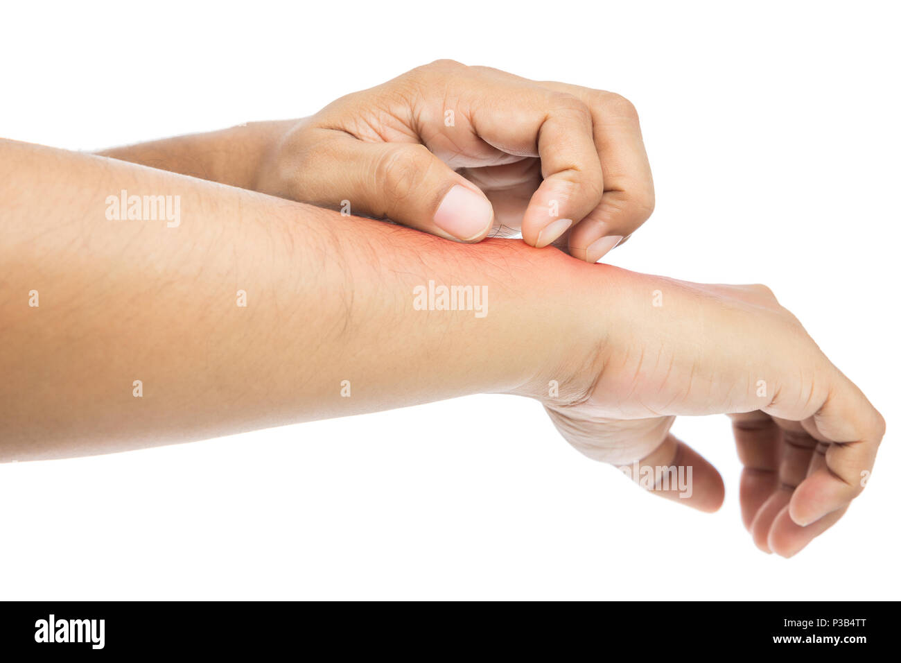 Wrist rash hi-res stock photography and images - Alamy