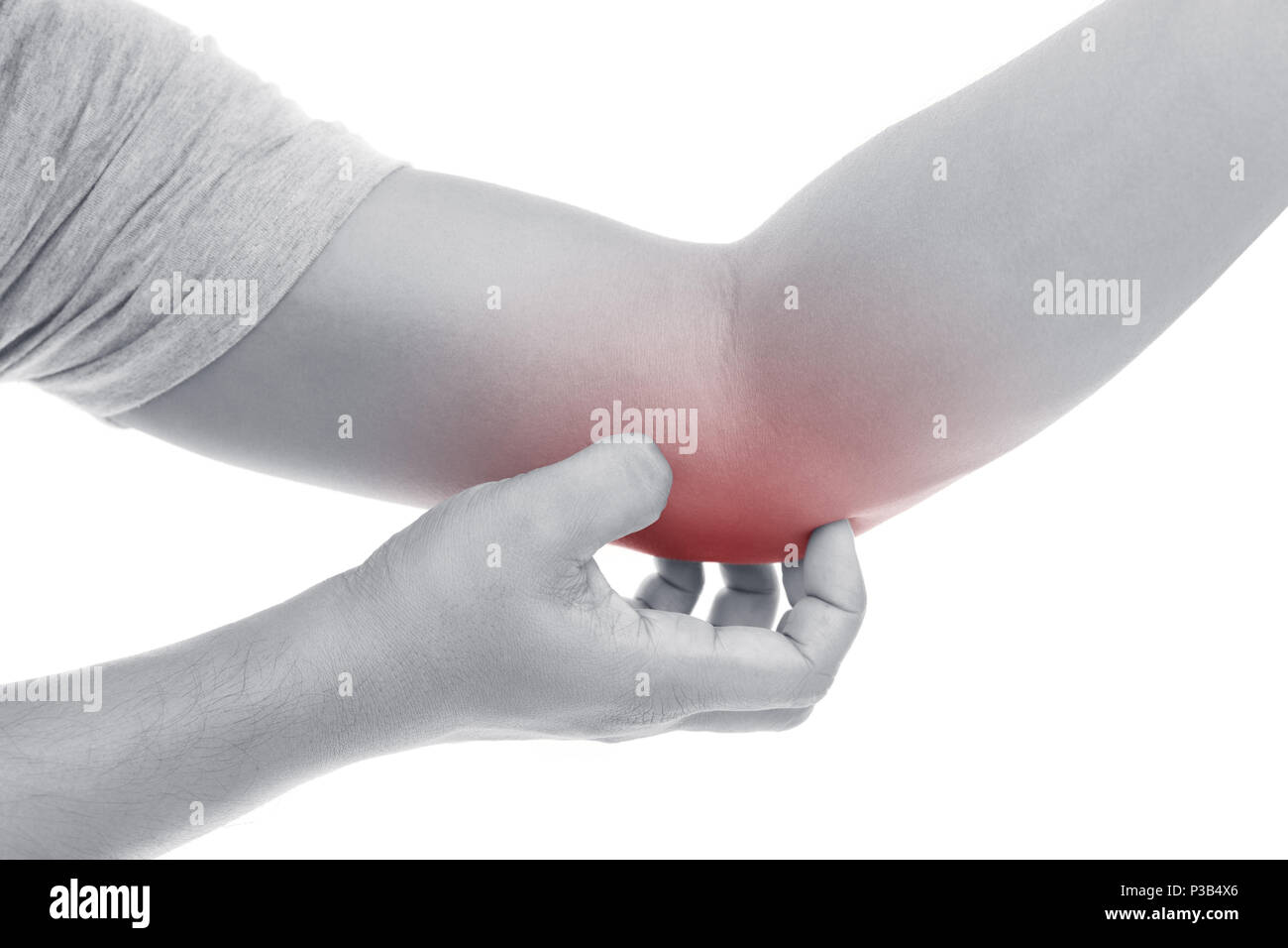 Eczema skin rash elbow arm hi-res stock photography and images - Alamy
