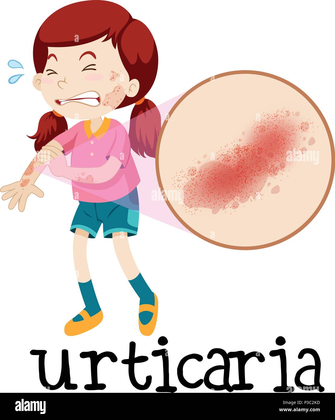 Urticaria vector vectors hi-res stock photography and images - Alamy