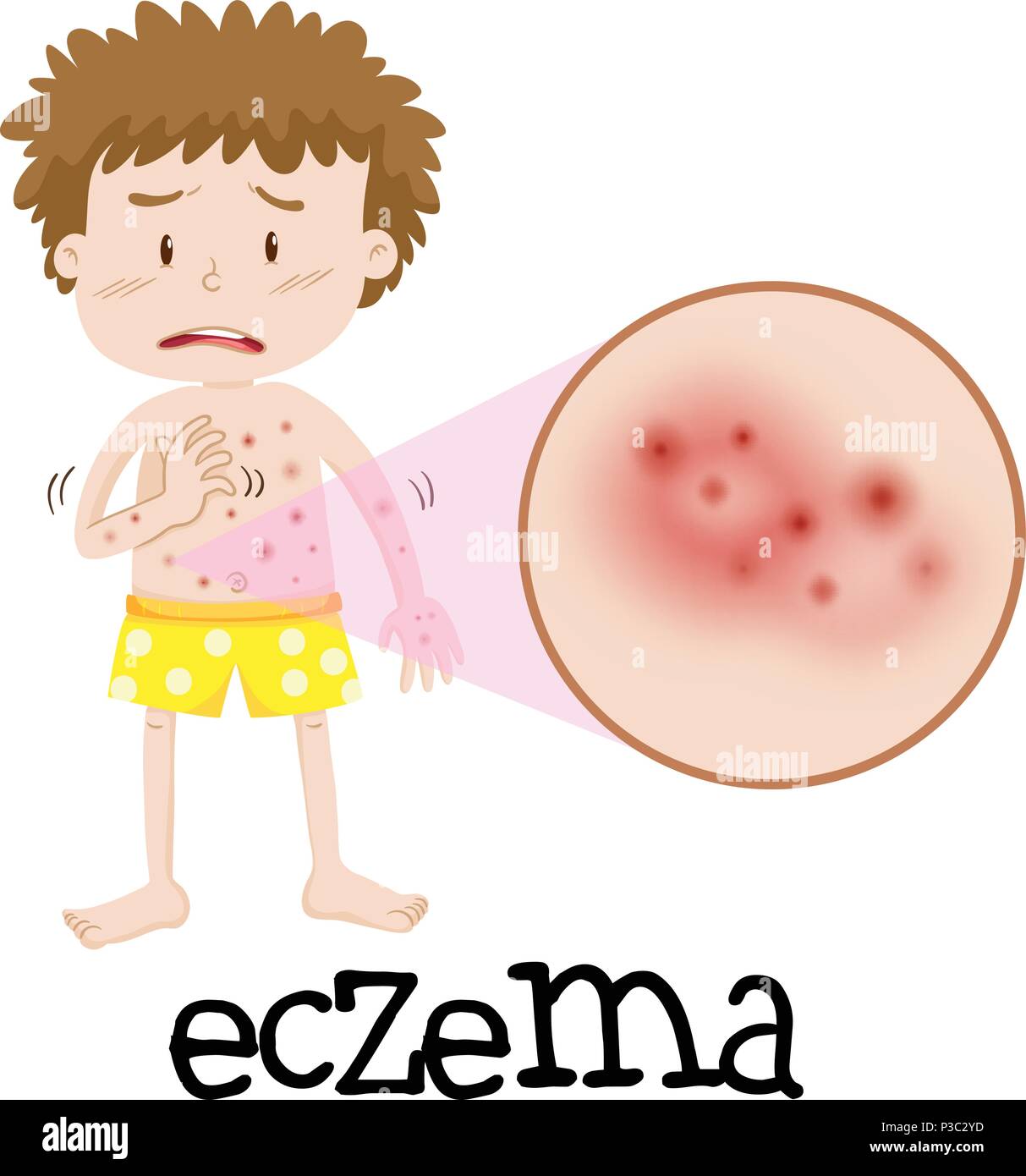 Young boy with magnified eczema illustration Stock Vector Image & Art ...