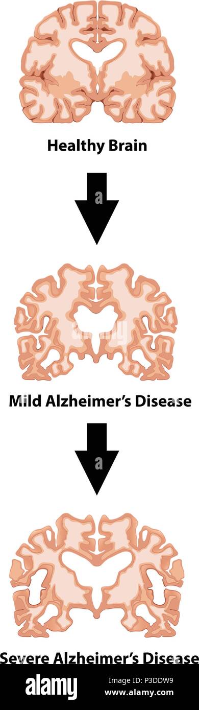 Stages of Alzheimers disease illustration Stock Vector Image & Art - Alamy
