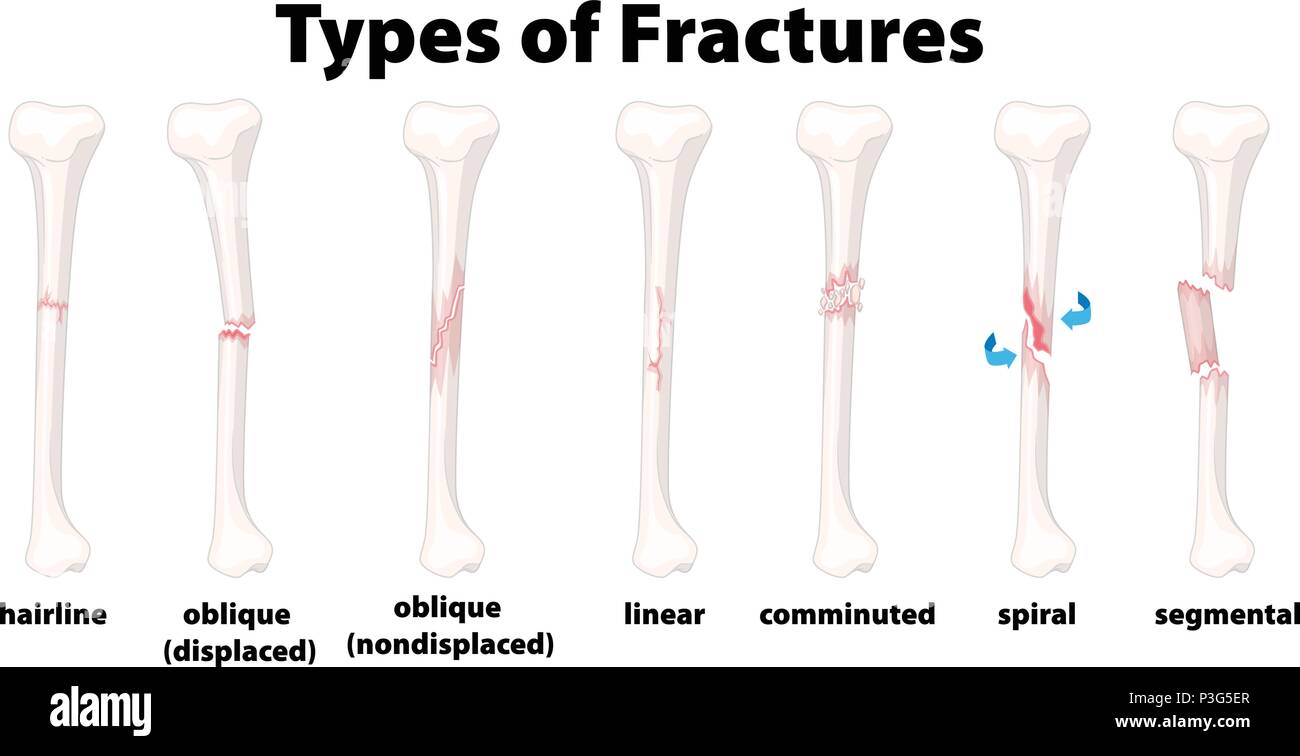 Fractures fractures Stock Vector Images - Alamy