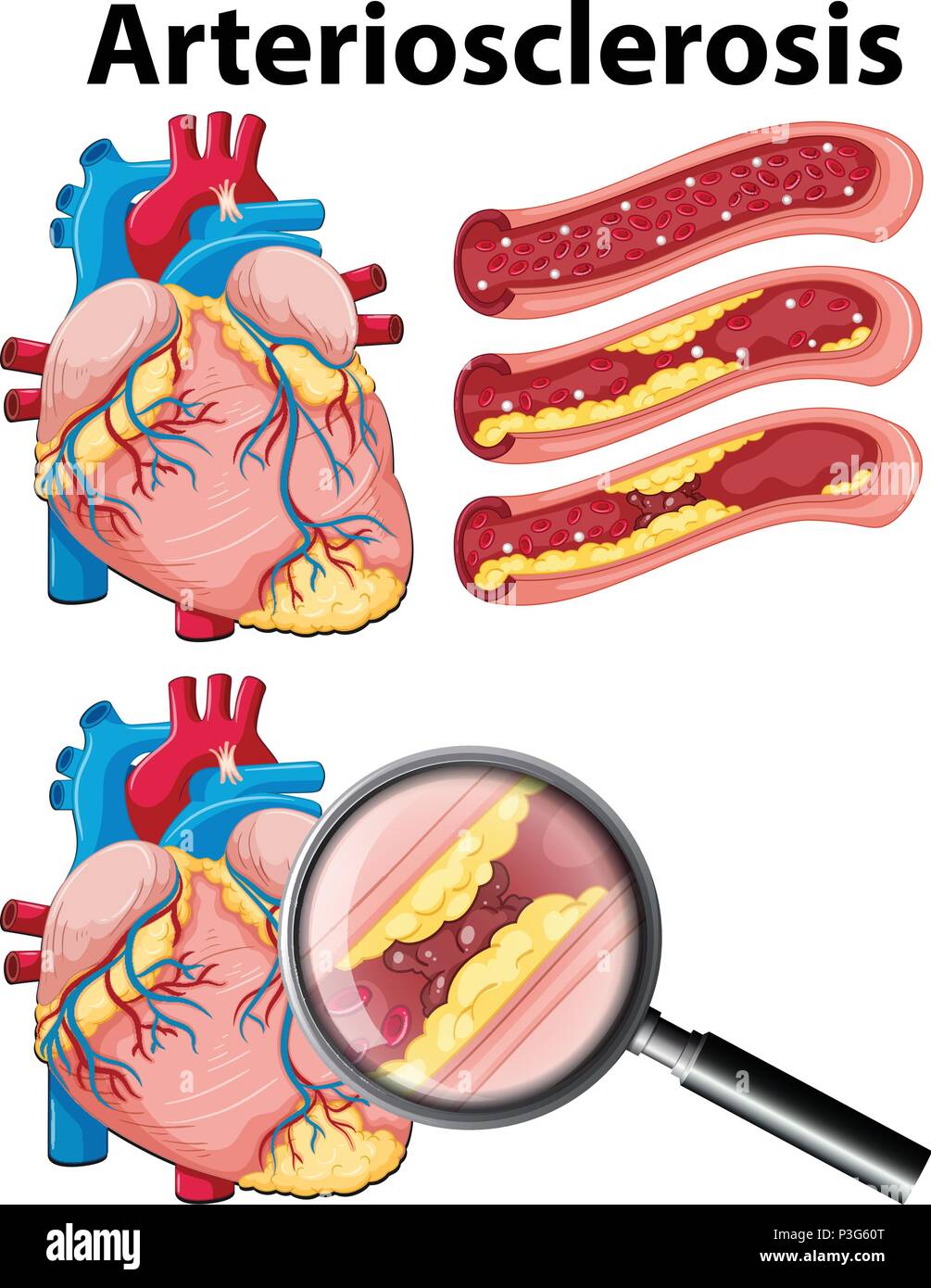 A Heart with Arteriosclerosis on White Background illustration Stock ...
