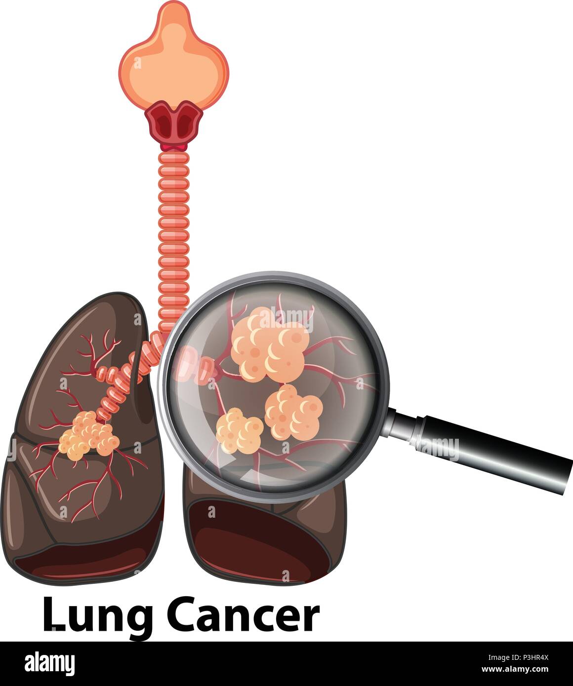 Lung Cancer Drawing High Resolution Stock Photography and Images - Alamy